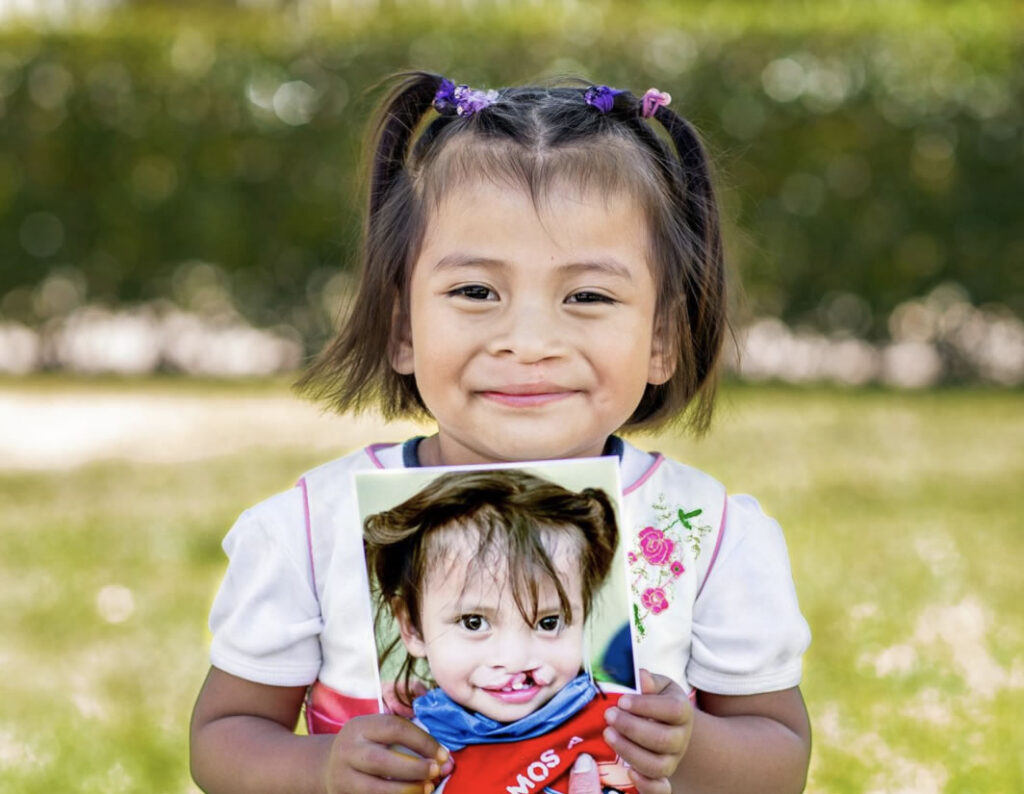 Smile Train México celebra el Día del Labio y Paladar Hendido - SaludyVida